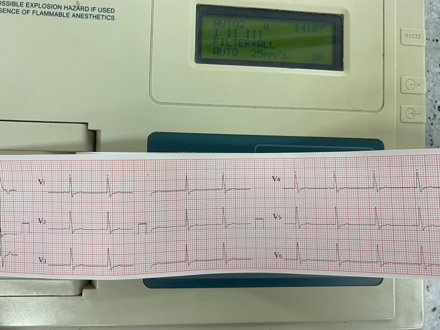 Secondhand Dongjiang ECG-32A 3 Channel ECG Device - Medbidding